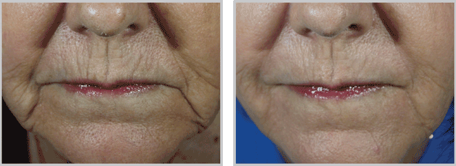 ProFractional™ Laser - Skin Artisans