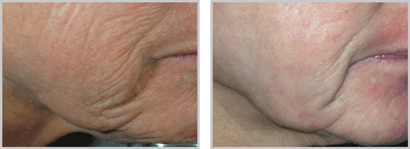 ProFractional™ Laser - Skin Artisans