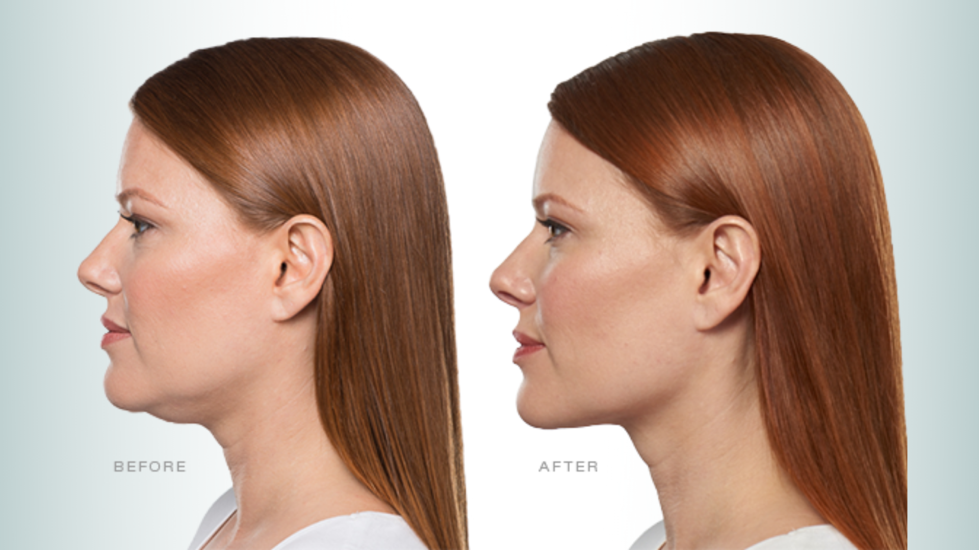 4 Ways to Address an Aging Neckline with Cosmetic Injectables - Skin ...