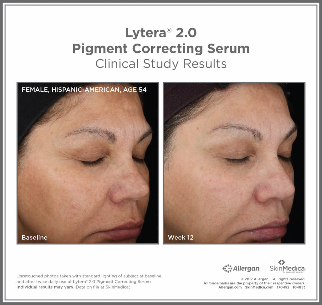 Managing Melasma – 3 Ways to Achieve a Clearer, More Even Complexion ...