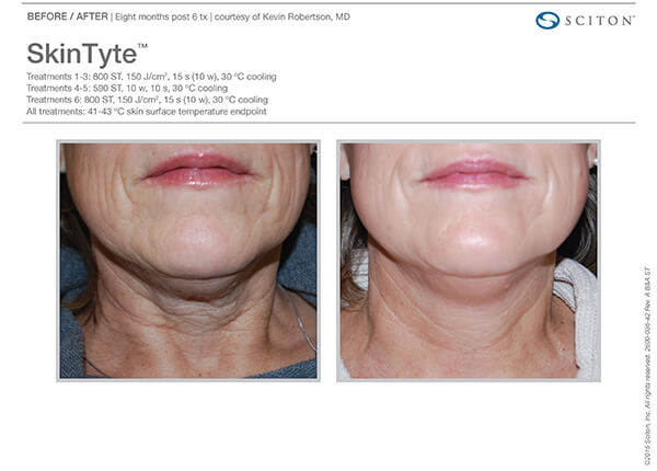 Smooth & Define Your Neckline with SkinTyte™ - Skin Artisans