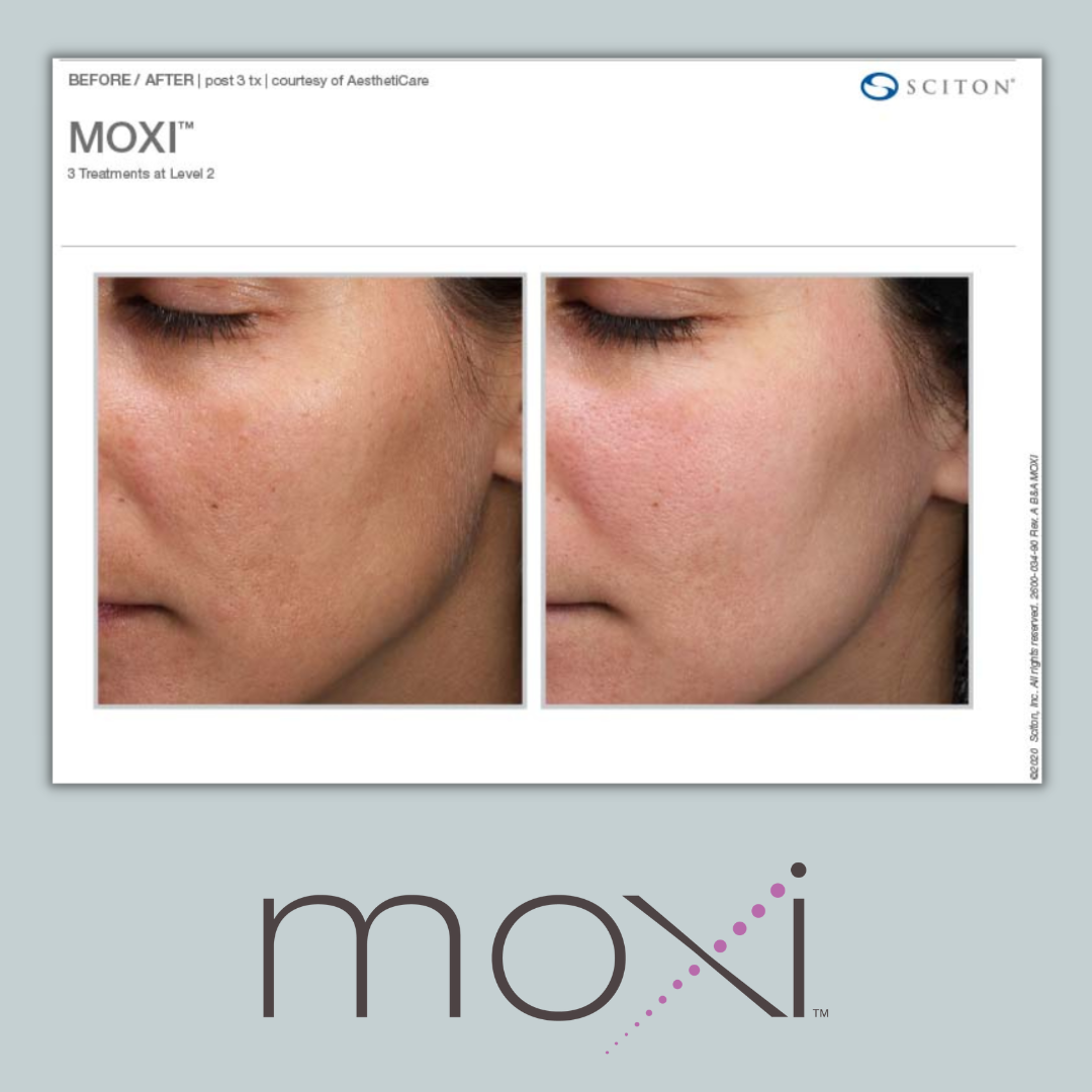 “PRE”juvenate Your Skin with MOXI™ Laser - Skin Artisans