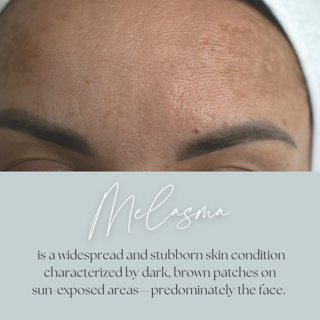 Get a Clear & Even Complexion with the Melasma Peel - Skin Artisans
