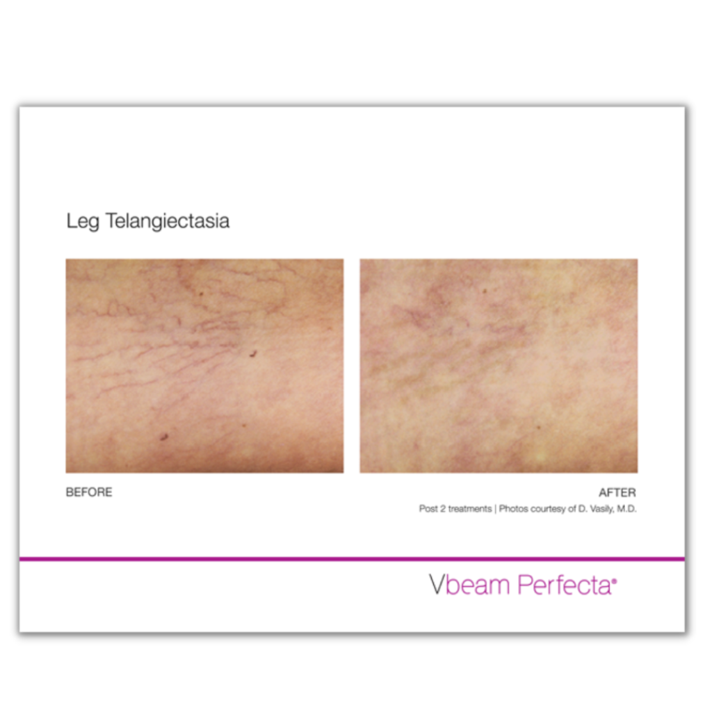 NEW! Vbeam Perfecta® – The Gold Standard in Vascular Treatments - Skin ...
