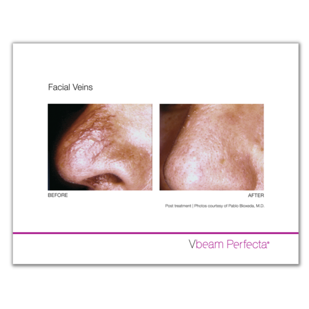 NEW! Vbeam Perfecta® – The Gold Standard in Vascular Treatments - Skin ...