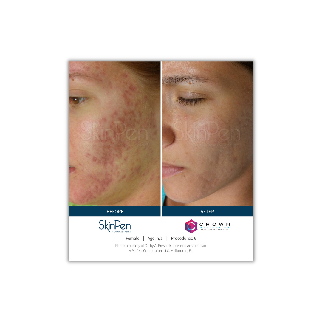 SkinPen® – The Gold-Standard in Microneedling - Skin Artisans