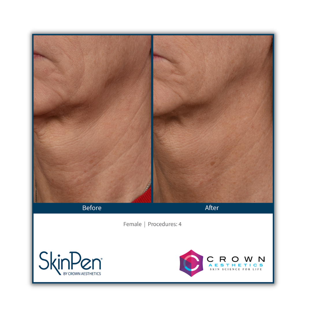 SkinPen® – The Gold-Standard in Microneedling - Skin Artisans