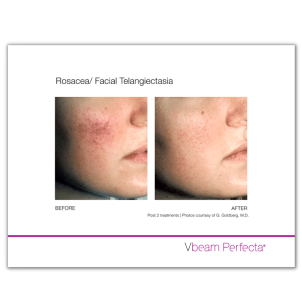 NEW! Vbeam Perfecta® – The Gold Standard in Vascular Treatments - Skin ...