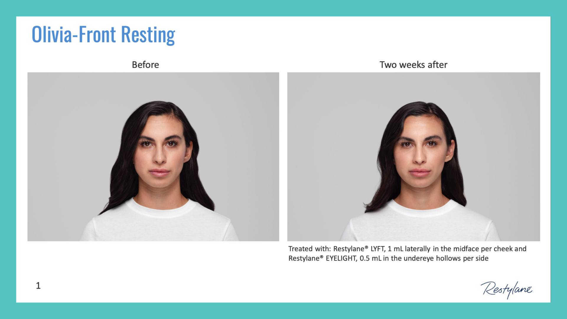 Look Refreshed & Awake with Restylane® EYELIGHT™ - Skin Artisans