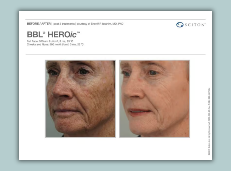 BBL® HEROic™ vs. Traditional BBL: What’s the Difference and Which One ...