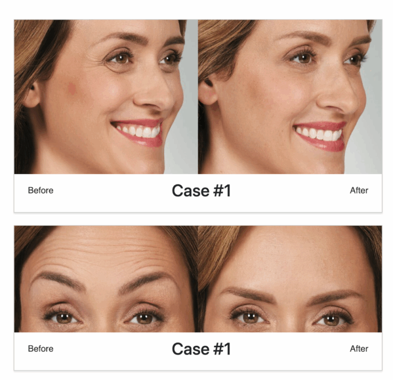 New to BOTOX®? Here Are 10 Things You Need to Know - Skin Artisans